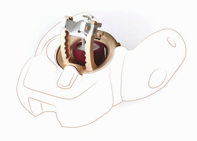 Prompt Flex - Module de dilatation et effacement du col - Mice Swiss